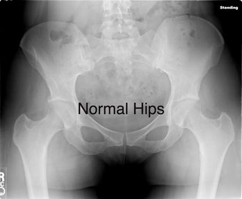 30 Year old with rheumatoid arthritis